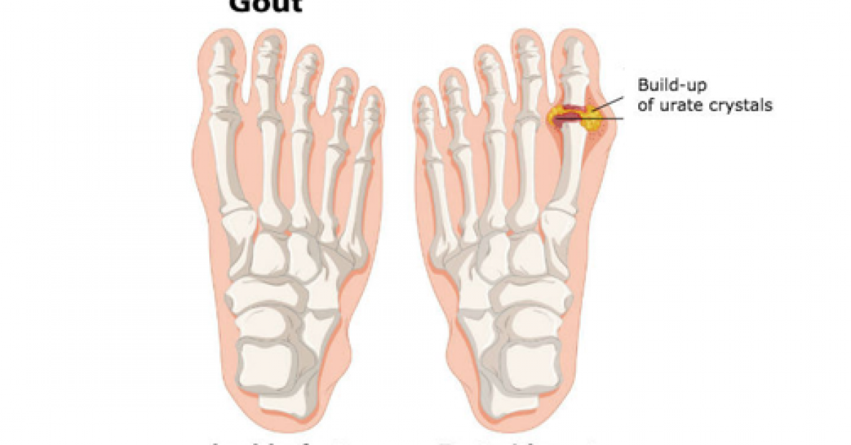 New Gout Combo Rx Approved – Padek Healthcare Pharmacy
